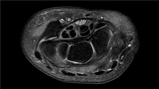PD Axial FS DR Sharp High Resolution-MAGNETOM Lumina - Siemens ...
