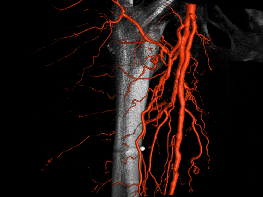 Interventional Radiology Systems - Siemens Healthineers India