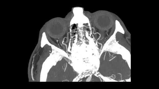 PCCT neurology imaging - Siemens Healthineers