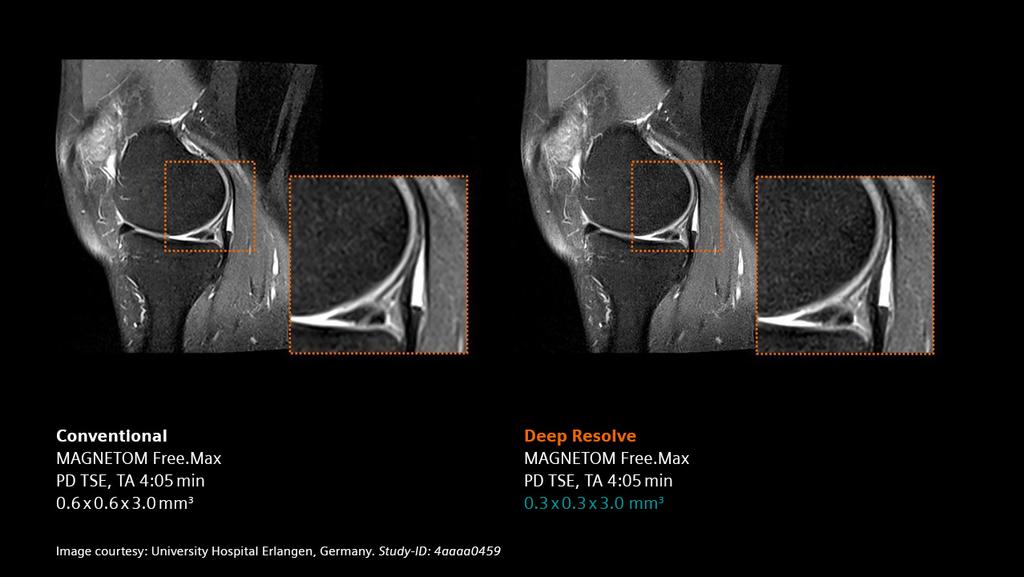 Deep Resolve - Siemens Healthineers