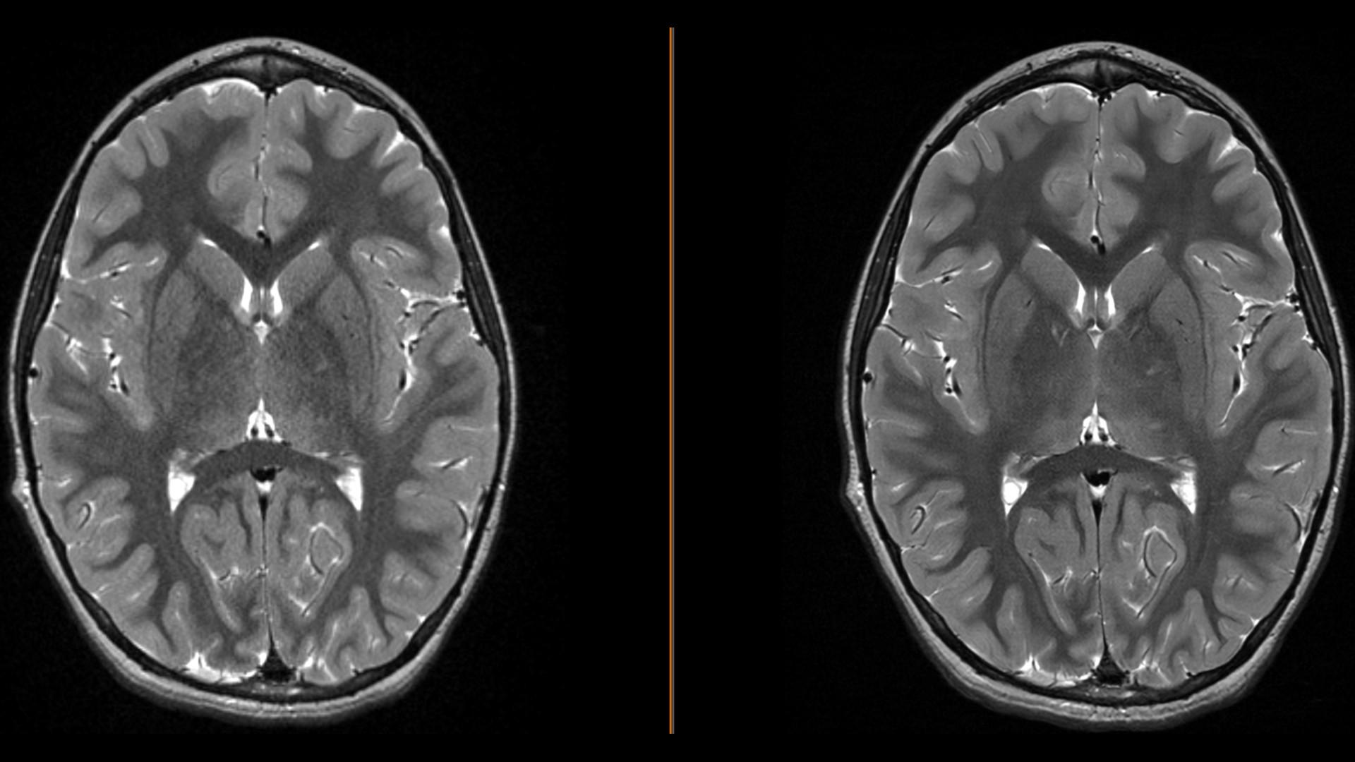 Pediatric protocols using Deep Resolve