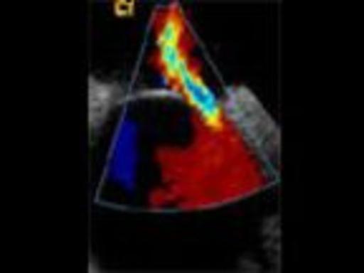 Coronary Angiography - Siemens Healthineers España