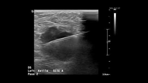 18F-FES PET/CT distinction of ER-positive lesions in a patient with ...