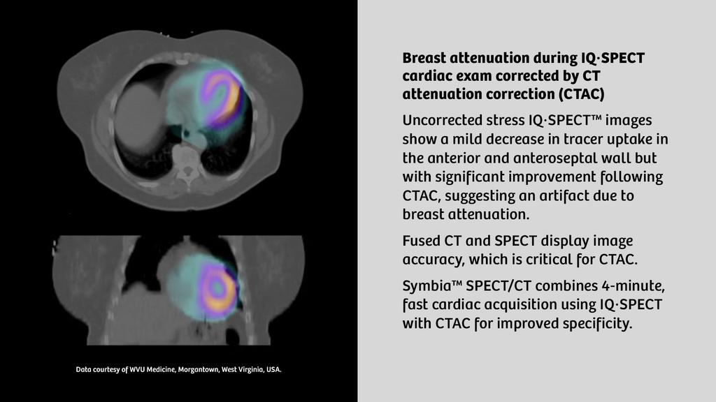 Moving SPECT/CT forward - Siemens Healthineers USA