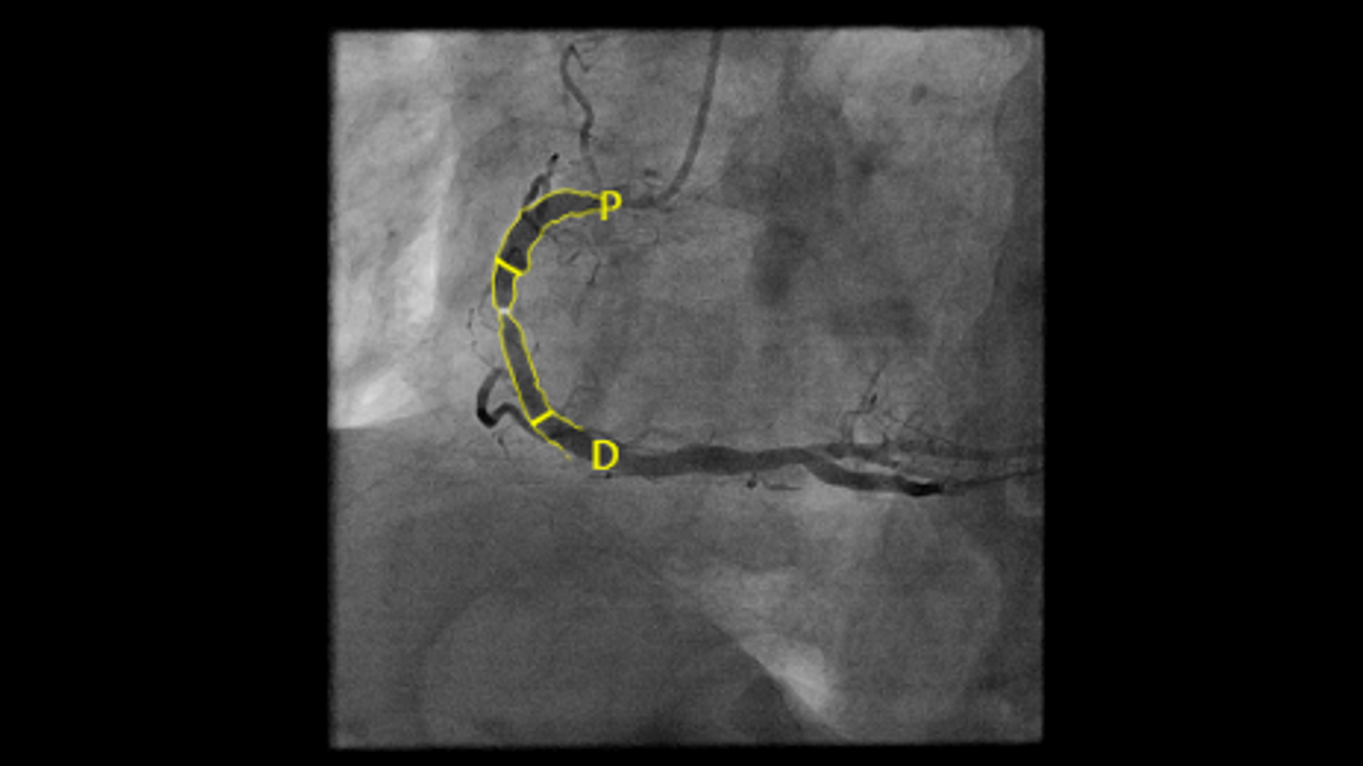 vFFR - angio-derived FFR measurements - Siemens Healthineers - Siemens ...