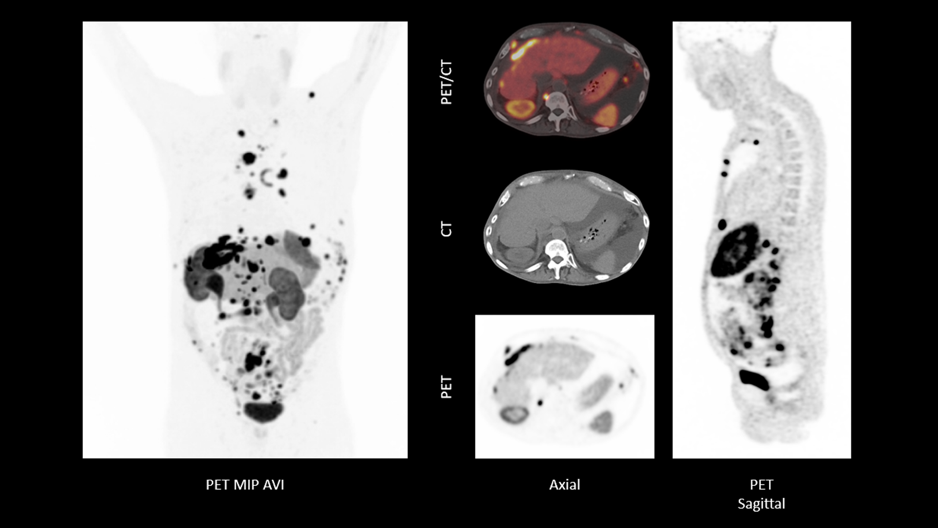 Theranostics clinical image gallery - Siemens Healthineers USA