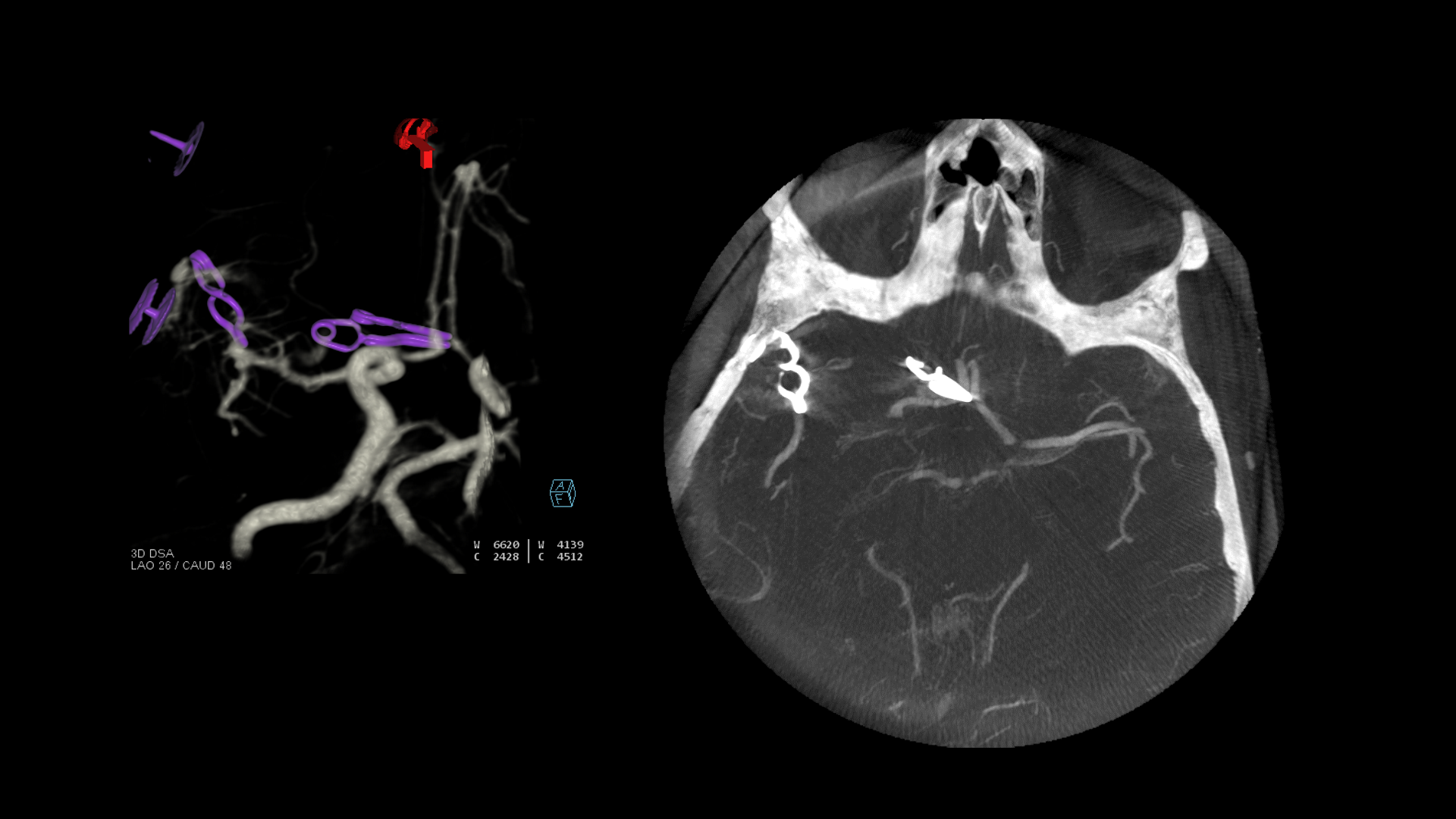 Secondary stroke prevention - Siemens Healthineers