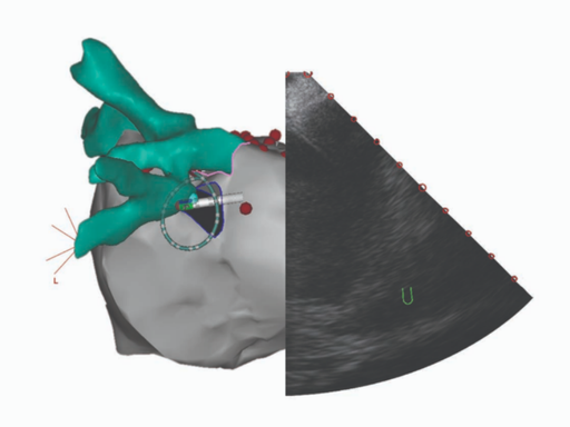 Milestones in Intracardiac Echocardiography - Siemens Healthineers USA
