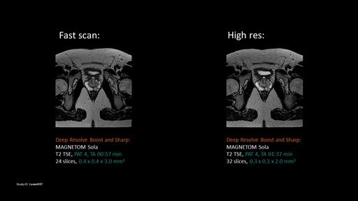 Deep Resolve - Siemens Healthineers