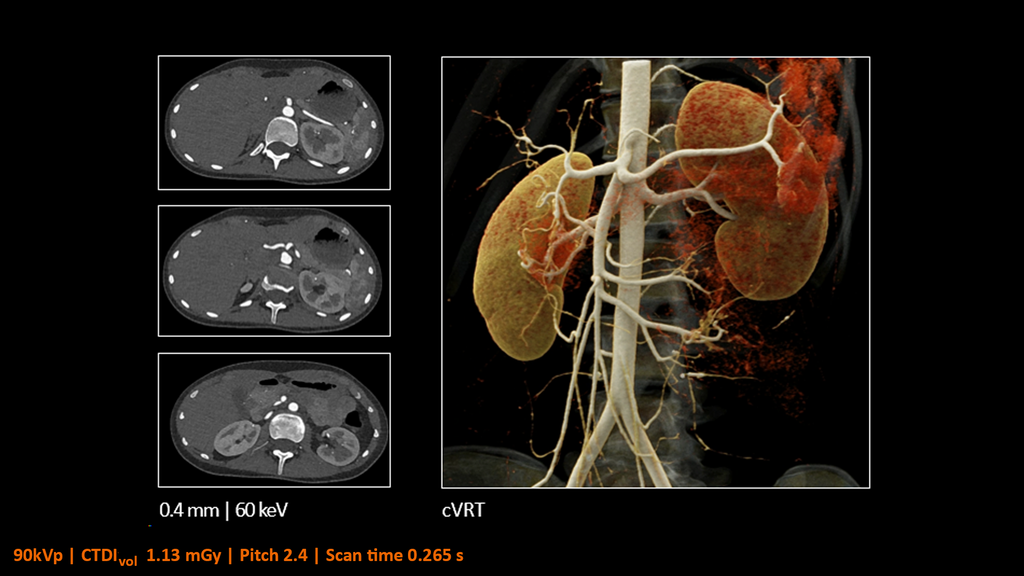 Dual Source CT - Siemens Healthineers