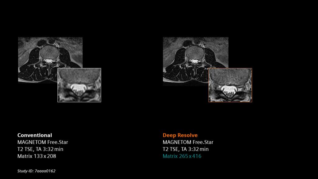 Deep Resolve - Siemens Healthineers