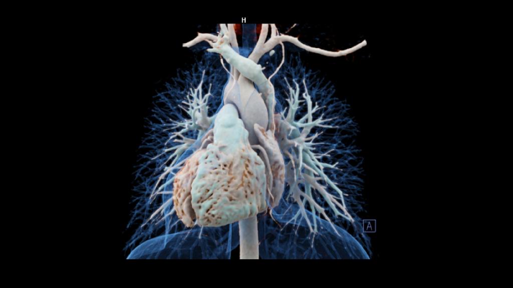 Situs inversus totalis discovered incidentally in an adult - Siemens ...