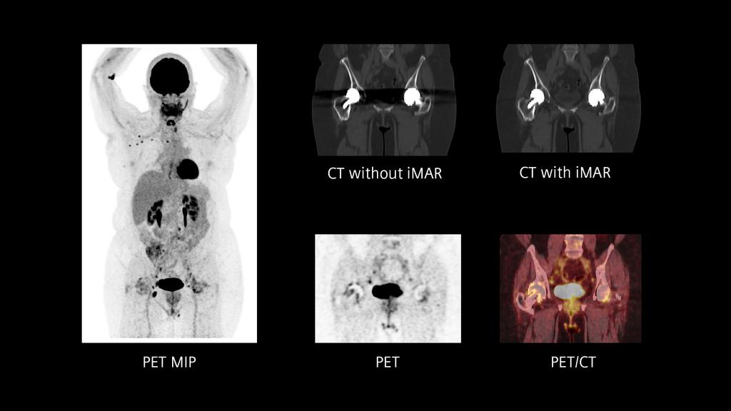 Biograph Trinion PET/CT scanner - Siemens Healthineers USA