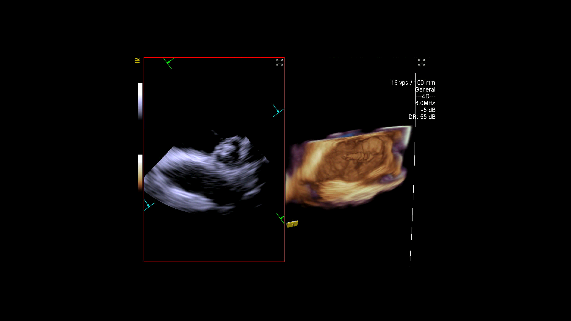 Secondary stroke prevention - Siemens Healthineers