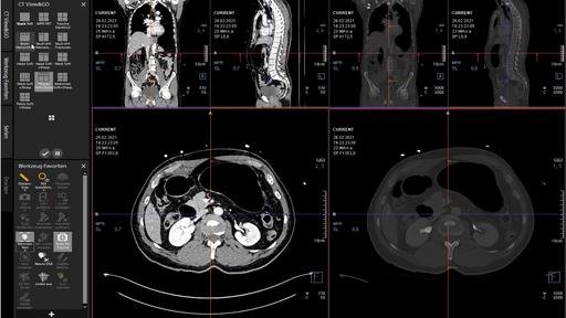 CT scanner SOMATOM go.Now with myExam Companion - Siemens Healthineers