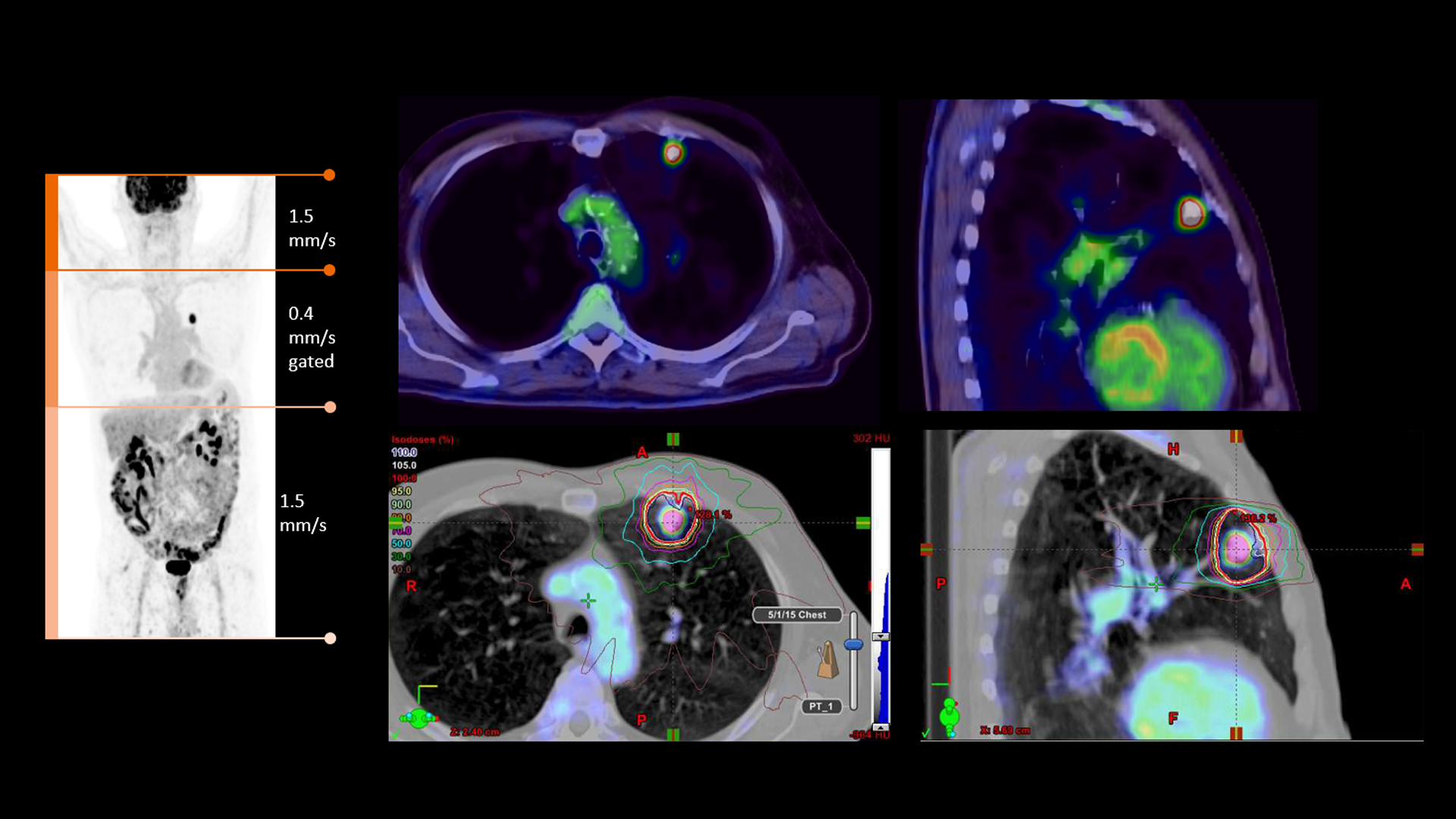Biograph PET/CT family for radiation therapy planning - Siemens Healthineers