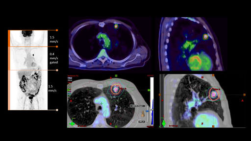 Biograph PET/CT family for radiation therapy planning - Siemens ...