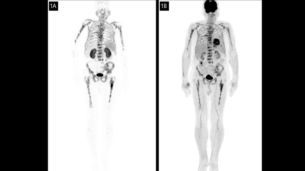 Theranostics by Nuclear Medicine Technology is a new hope for Prostate ...