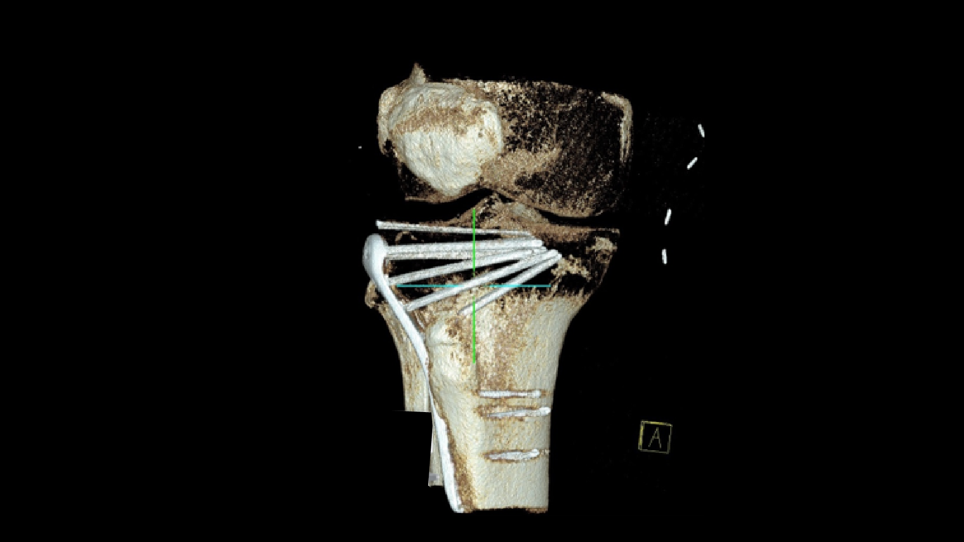 Tibia proximal - Siemens Healthineers Latinoamérica