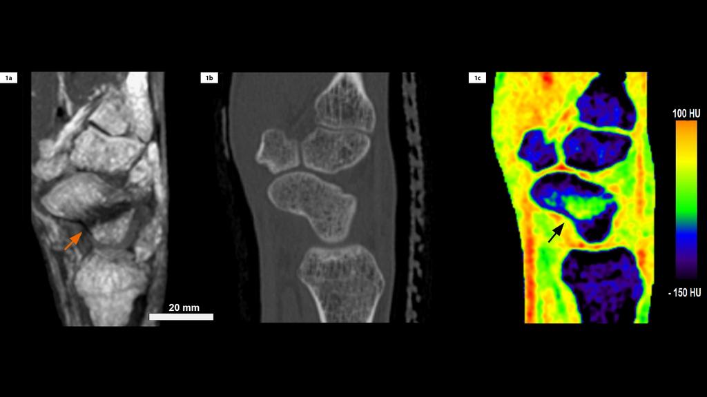 Scaphoid fracture associated bone marrow edema