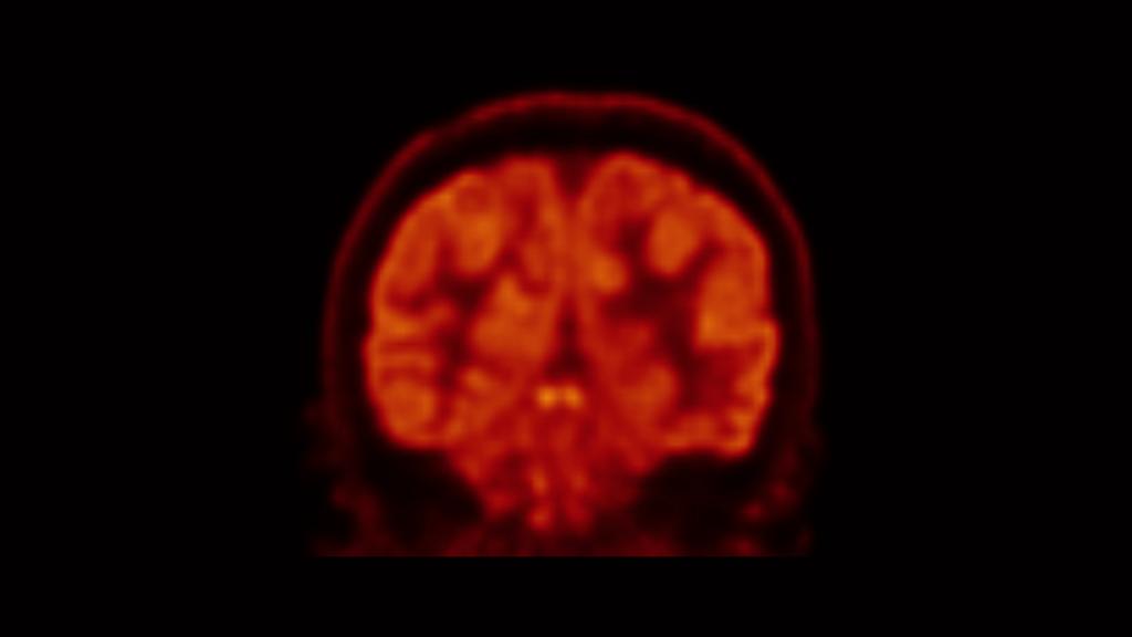 PETNET on neurology - Siemens Healthineers