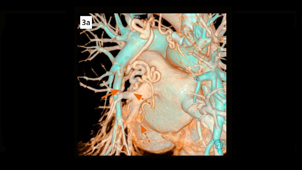 Hemoptysis secondary to systemic vascular hypertrophy and bronchial ...