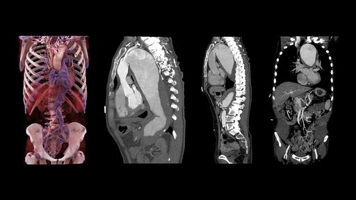 SOMATOM Edge Plus - Siemens Healthineers USA