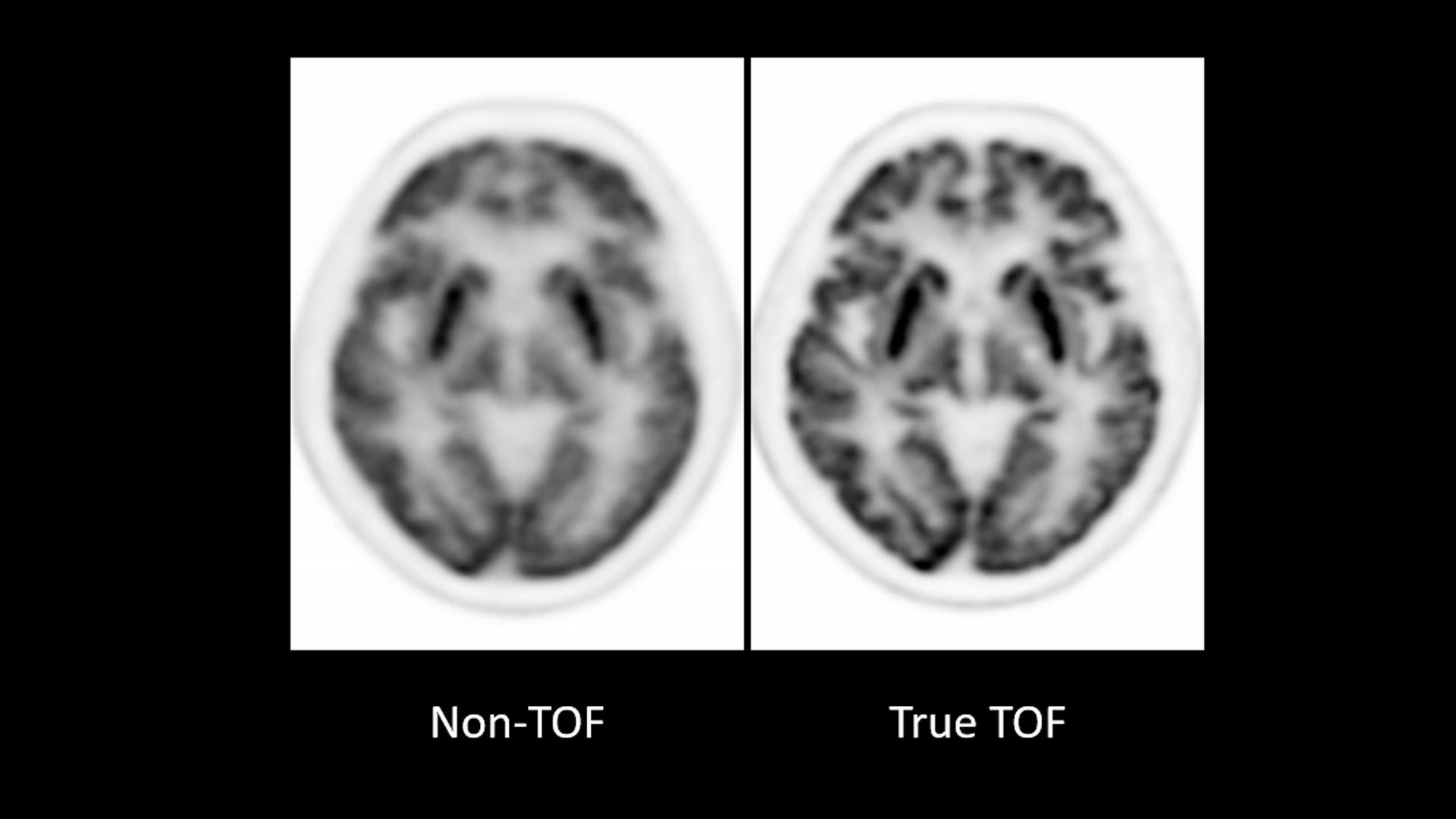 True TOF technology - Siemens Healthineers