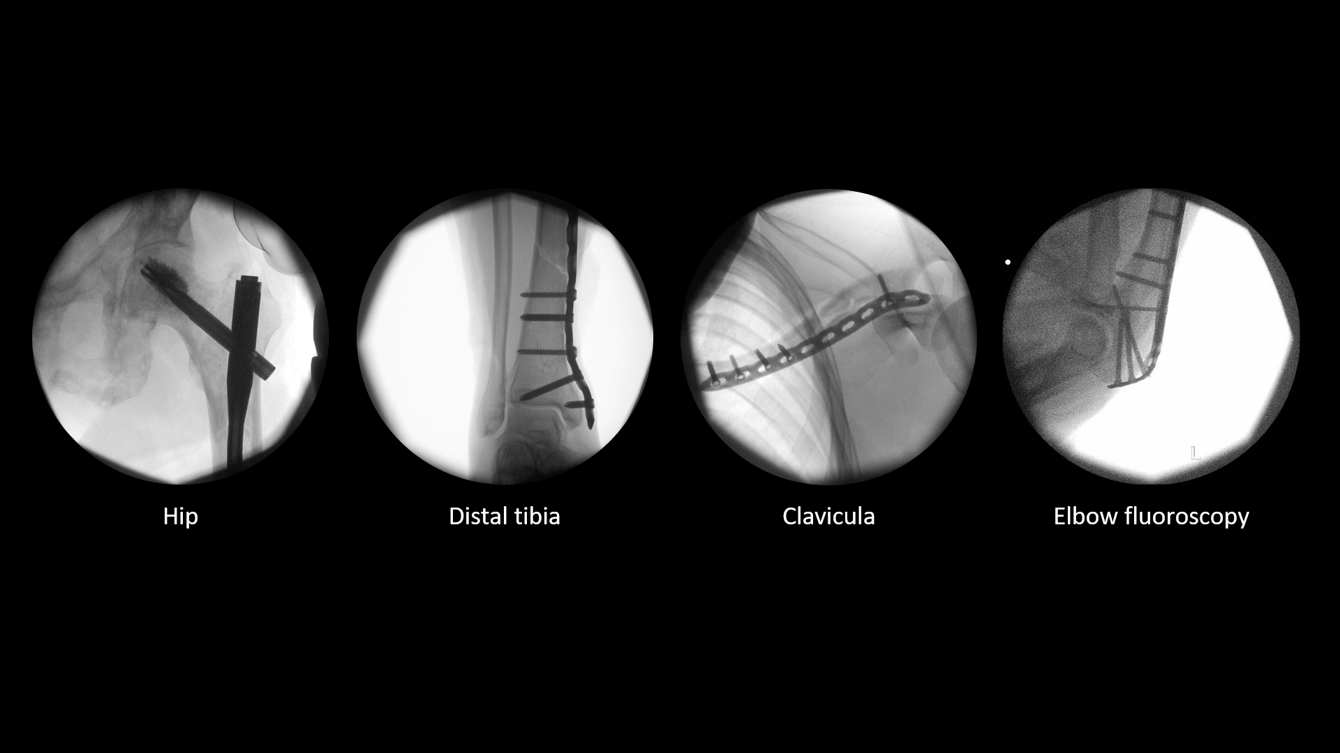Mobile C-arm machine - Cios Select - Siemens Healthineers