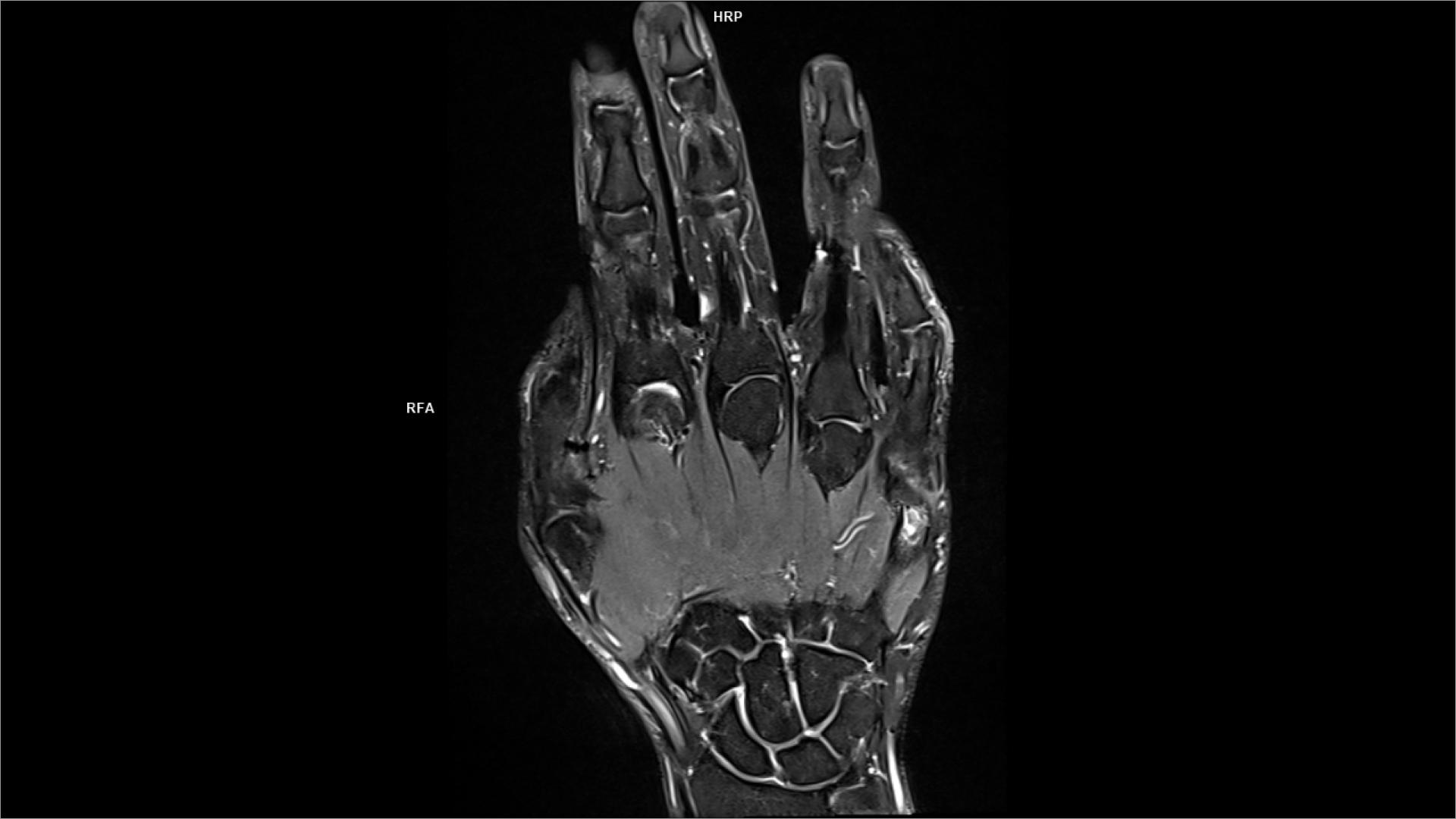 Coronal PD tse FS-MAGNETOM Altea - Siemens Healthineers USA