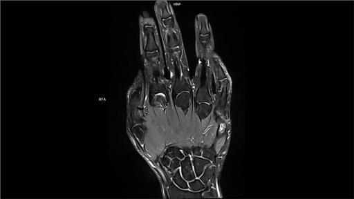 Coronal PD tse FS-MAGNETOM Altea - Siemens Healthineers USA