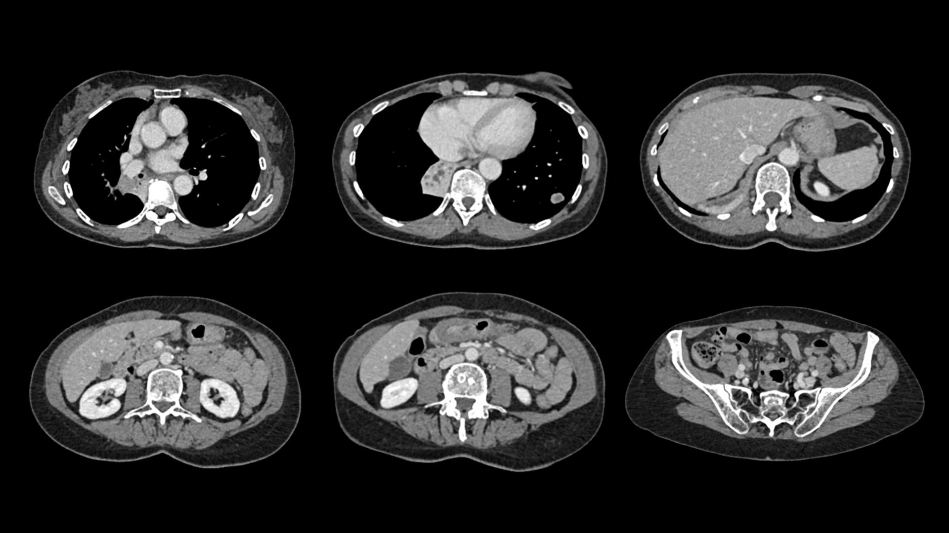 SOMATOM Go.top — Hecho a la altura - Siemens Healthineers Latinoamérica