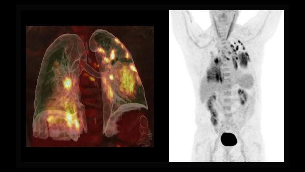 Incidental findings of COVID-19 in PET/CT imaging - Siemens Healthineers