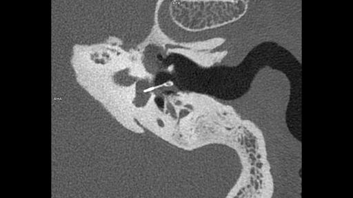 PCCT neurology imaging - Siemens Healthineers