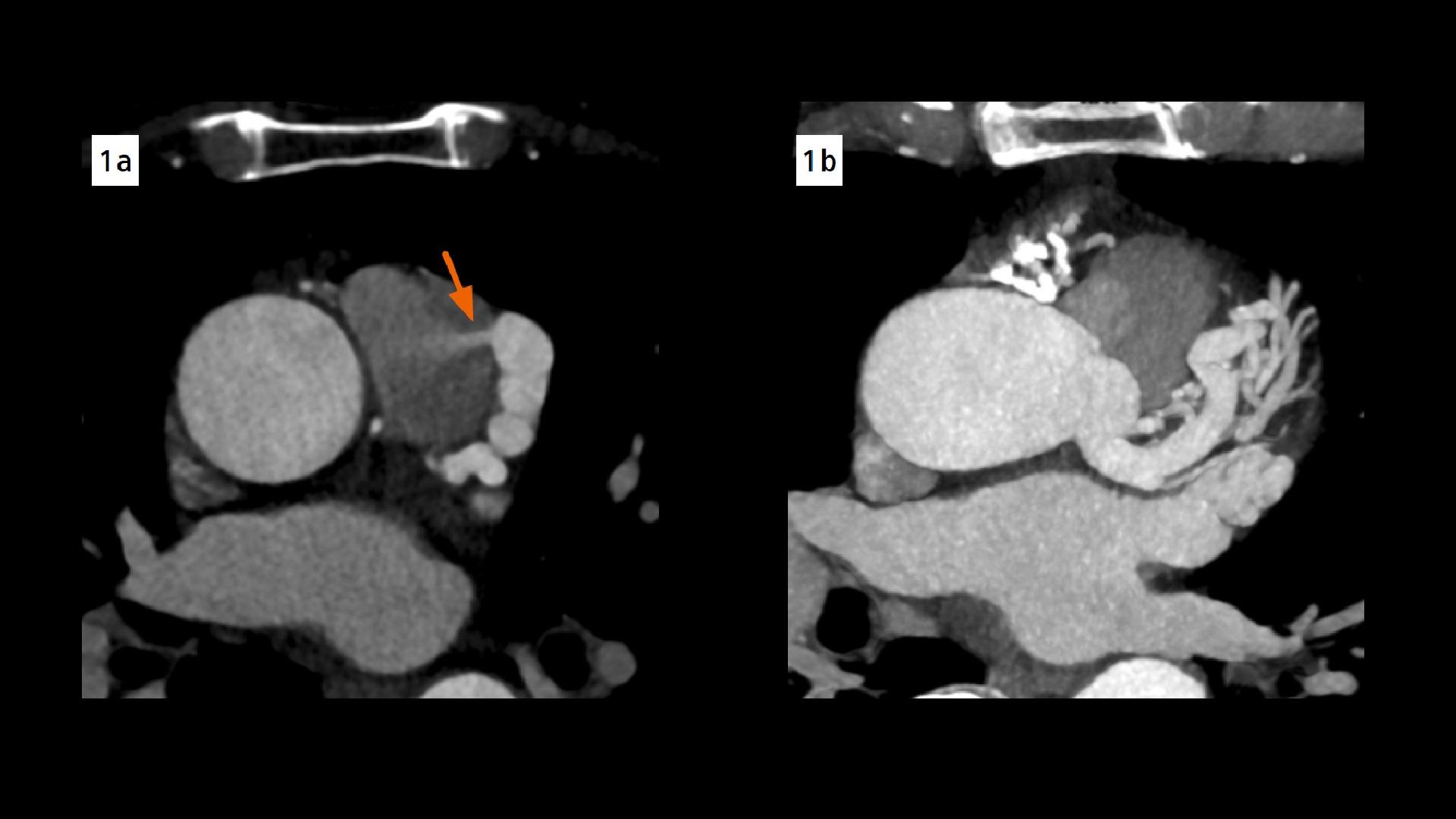 A Complex Coronary Arteriovenous Fistula - Siemens Healthineers USA