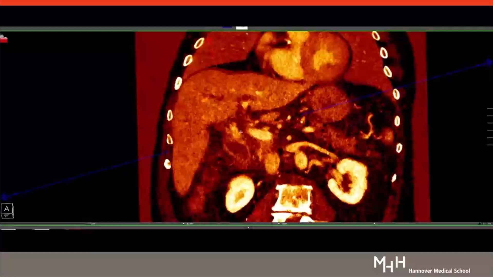 PCCT scientific evidence - Siemens Healthineers