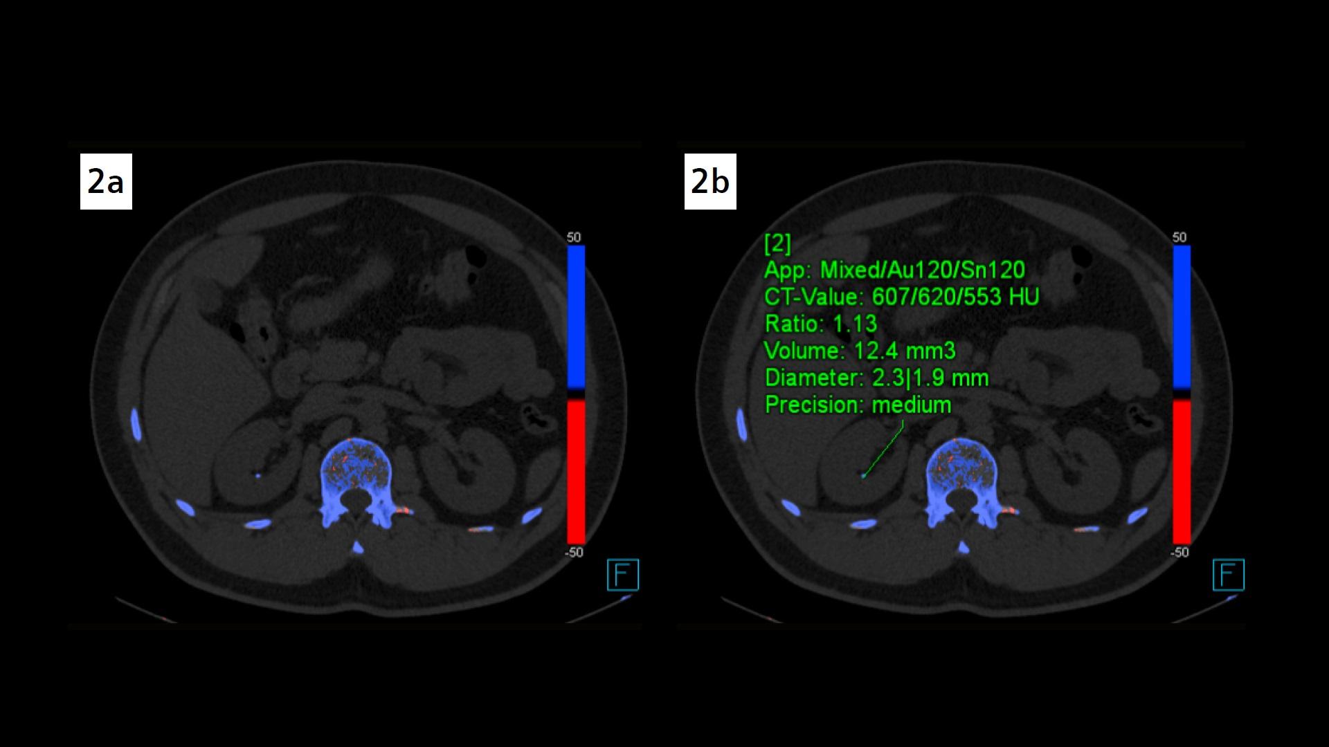 Small-sized renal calculi – uric acid or non-uric acid? - Siemens ...