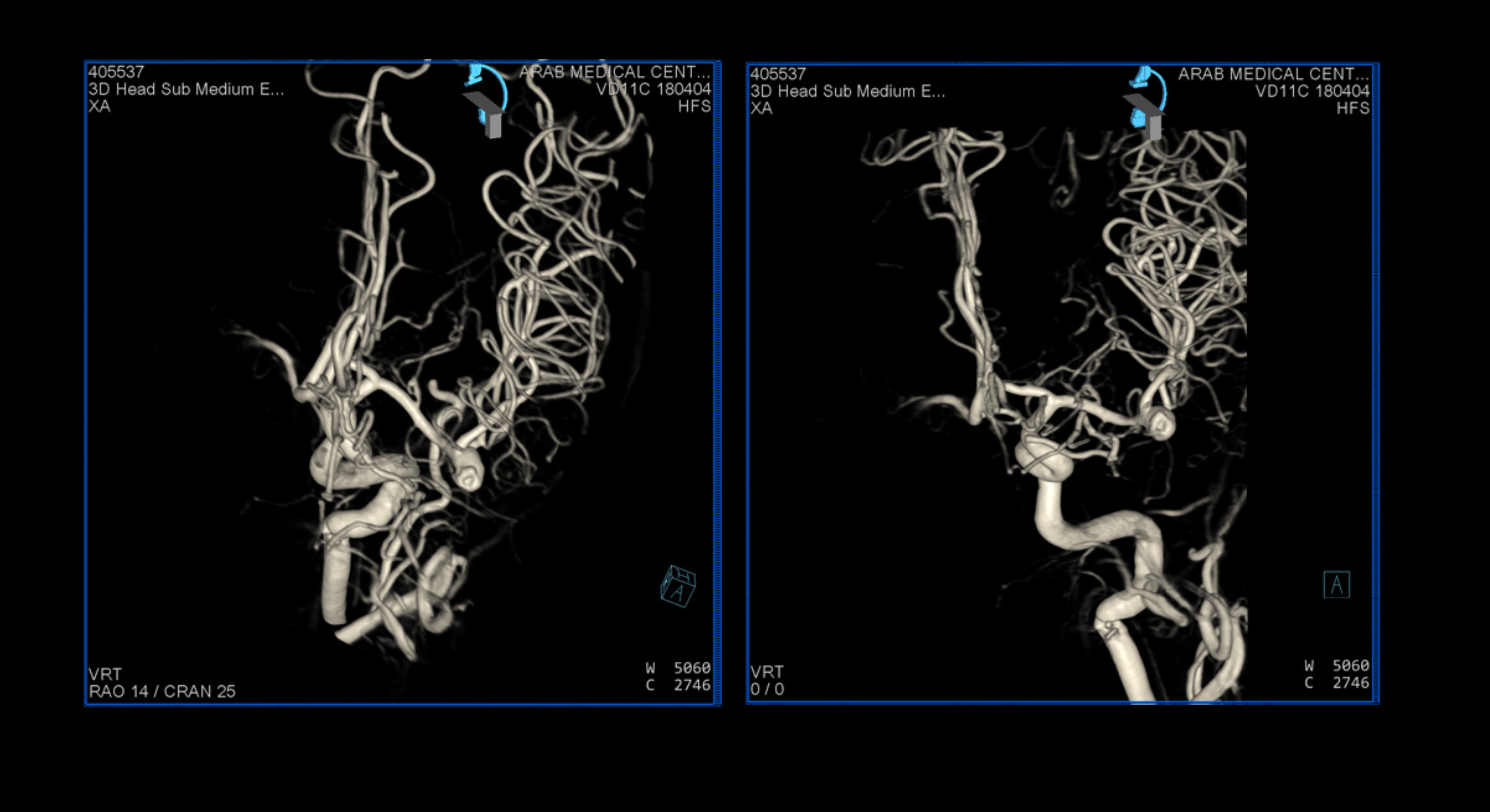 Clinical Advantage of 3D Imaging in Intracranial Aneurysm