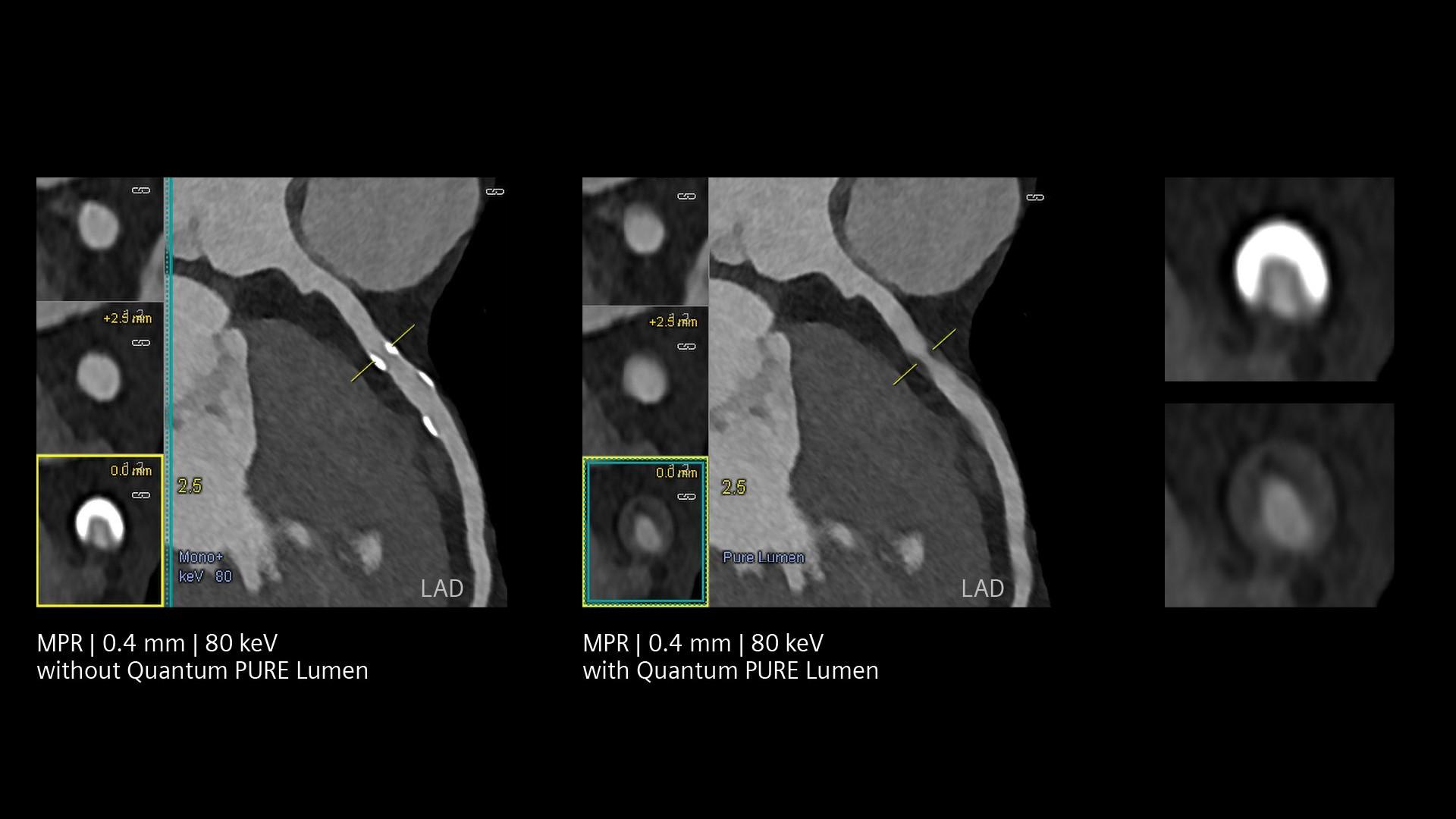 PCCT cardiovascular imaging - Siemens Healthineers