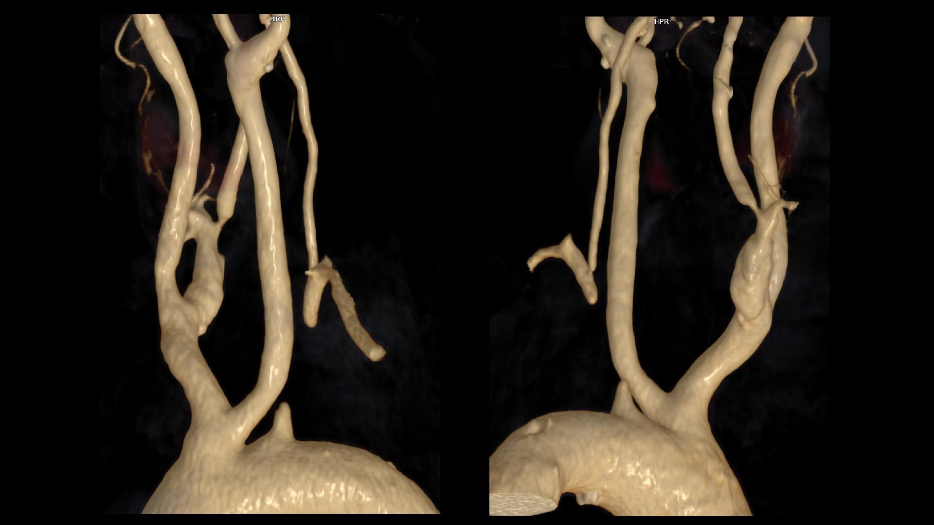 SOMATOM Pro.Pulse Dual Source CT scanner - Siemens Healthineers USA