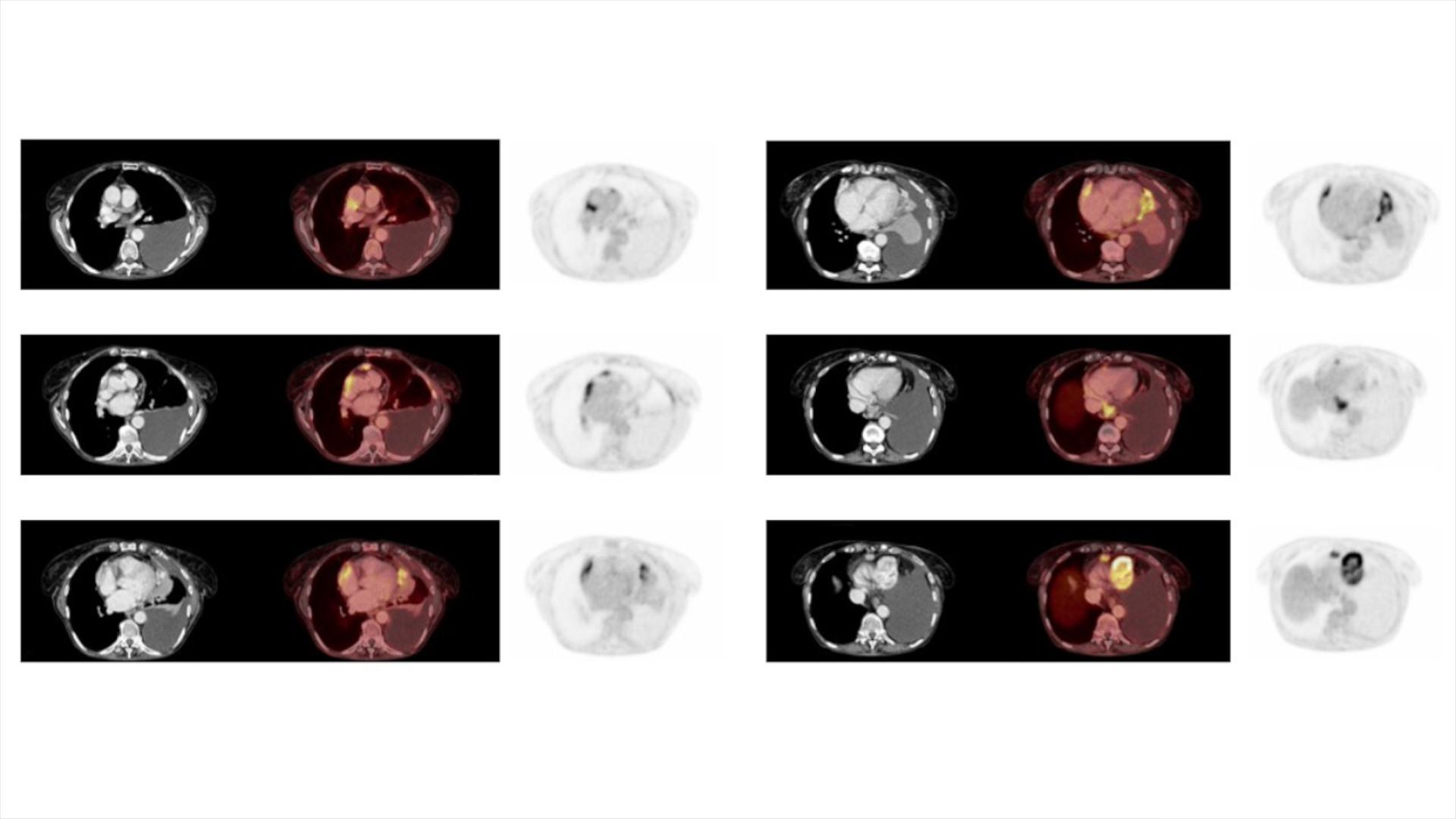 18F-FDG PETCT delineation of predominantly pericardial involvement in ...
