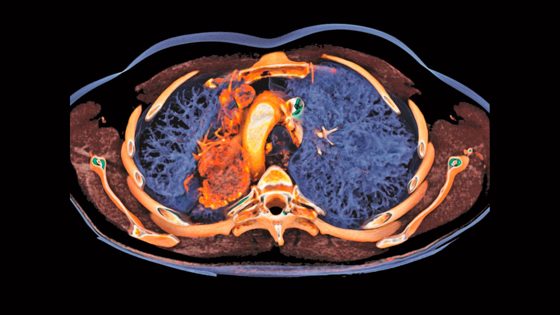 Computed Tomography - Siemens Healthineers