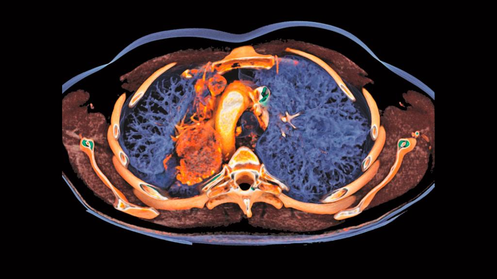 Computed Tomography - Siemens Healthineers