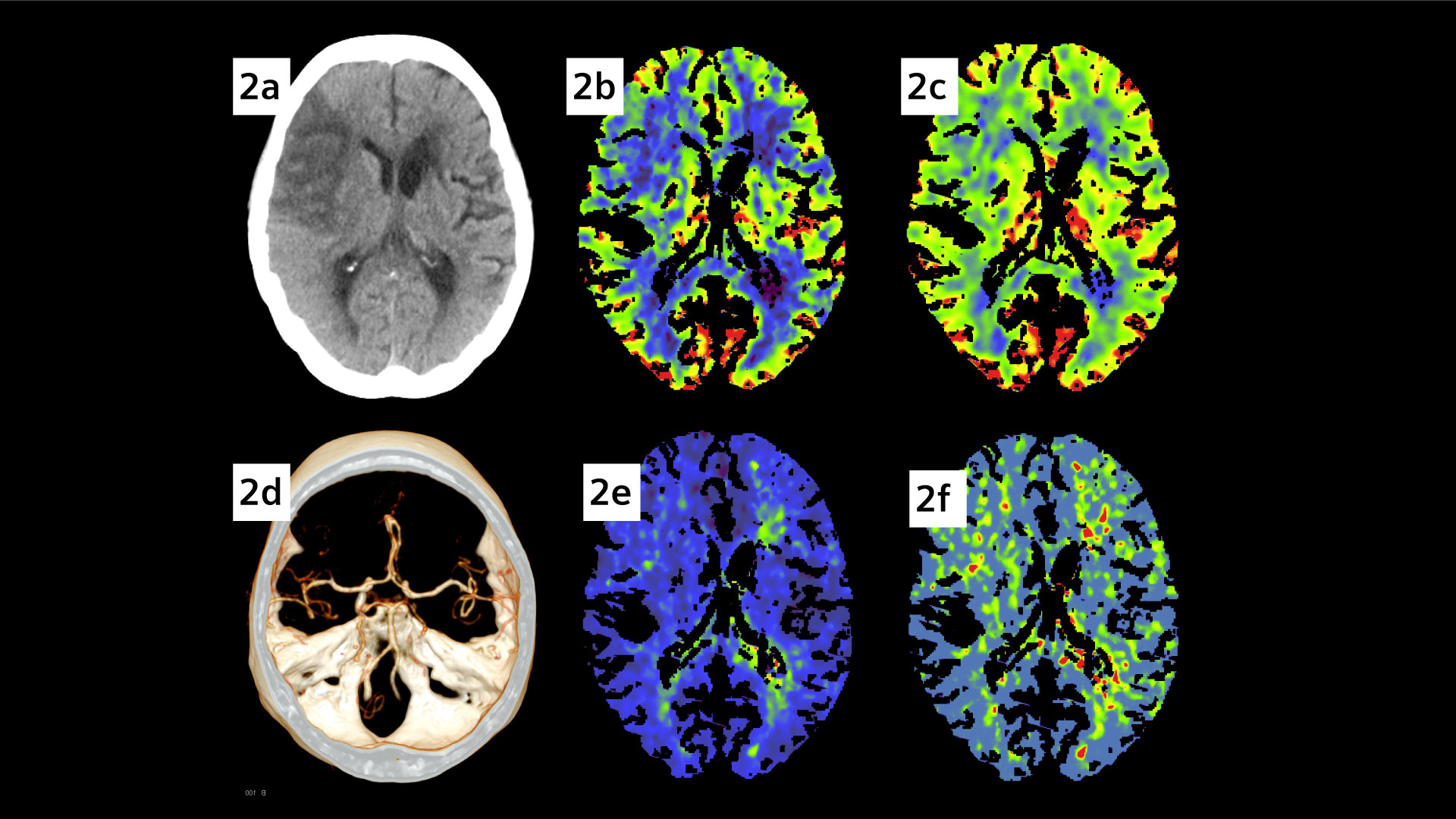 Accidente Cerebrovascular Isquémico Agudo – Perfusión Cerebral Antes y ...