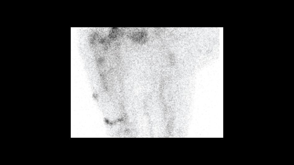Localization Of Infection Site In Femoral Stabilization Pin - Siemens ...