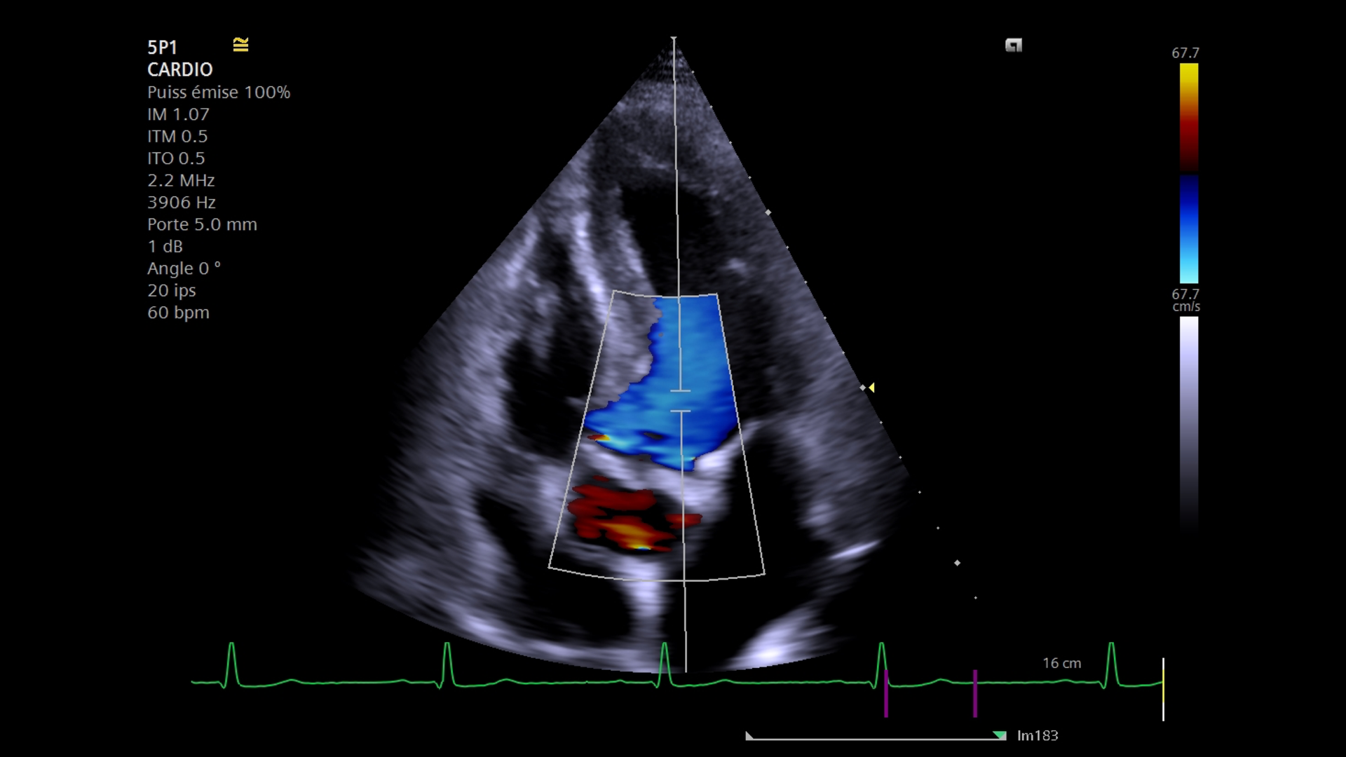 Rétrécissement aortique calcifié : écho-Doppler transthoracique ...