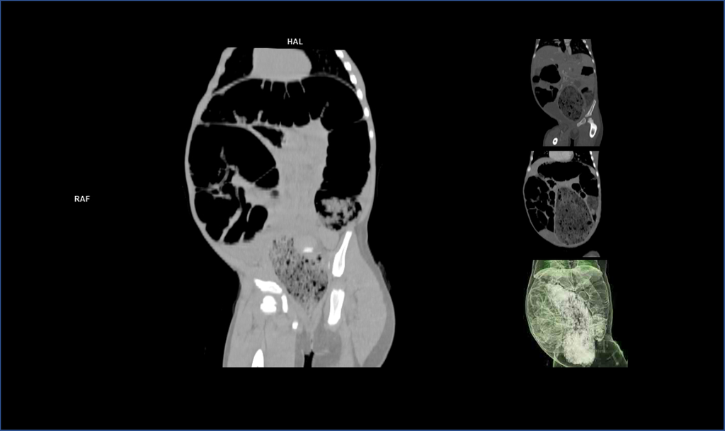 Hirschsprung’s Disease (HD) - Congenital Megacolon Child Imaging with ...