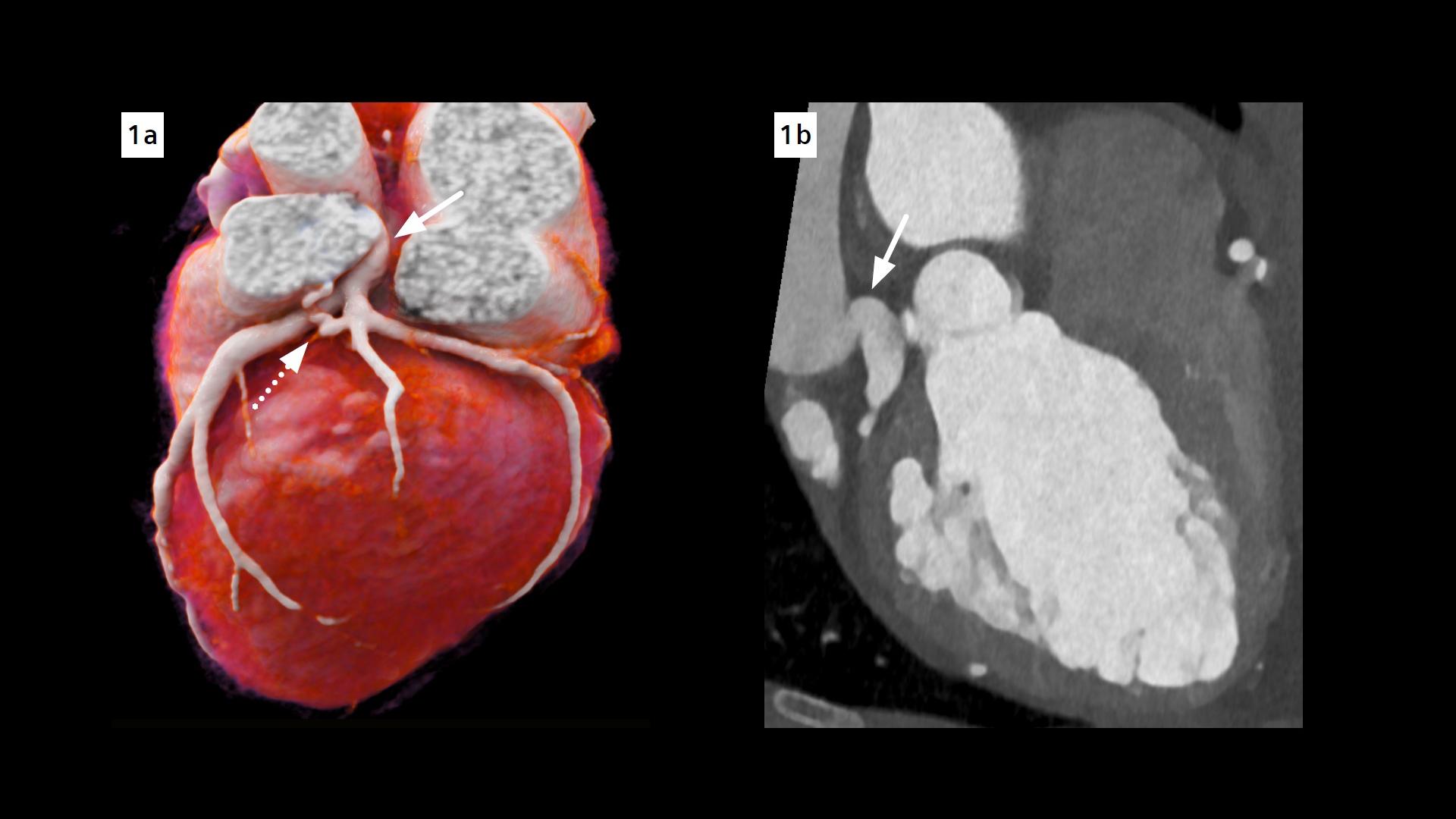 An adult type of Bland-White-Garland syndrome - Siemens Healthineers ...