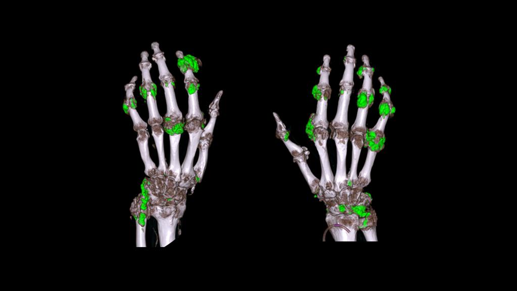 SOMATOM Definition Edge - Siemens Healthineers India