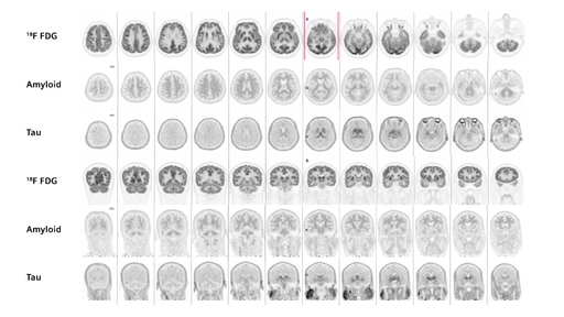 Biograph Vision PET/CT Clinical Image Gallery - Siemens Healthineers